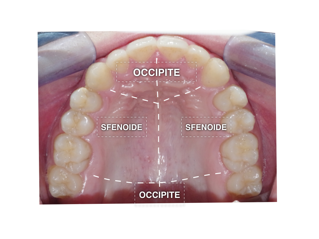 Il palato direttivo o adattativo. – OP Analysis